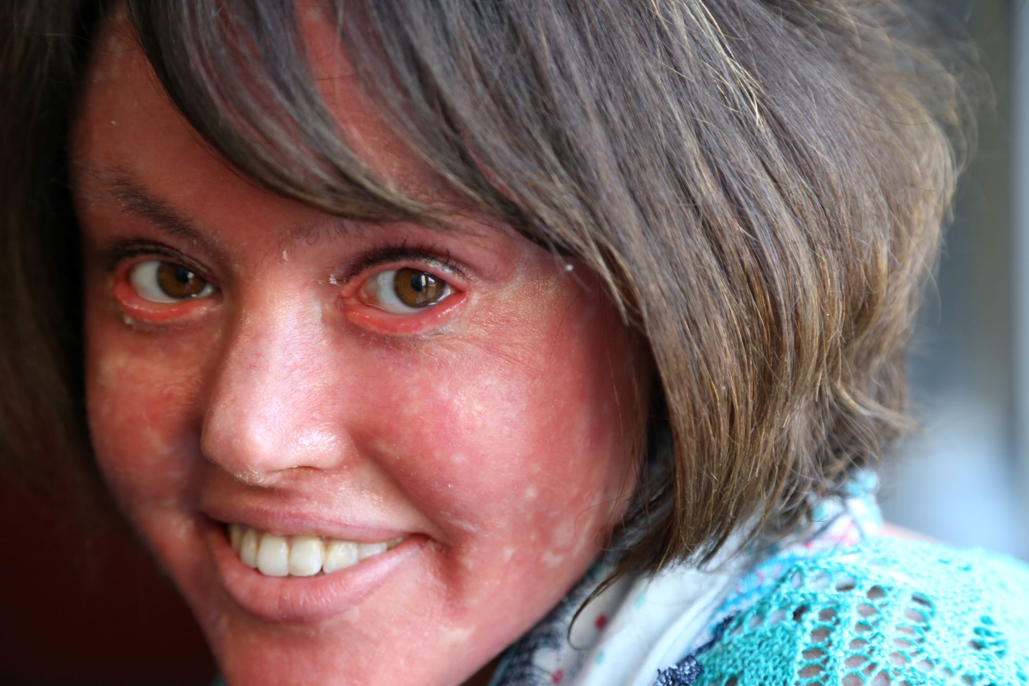 Redefining Beauty Standards: Portia Cina Shares Her Journey with Ichthyosis Confetti - Real News Now